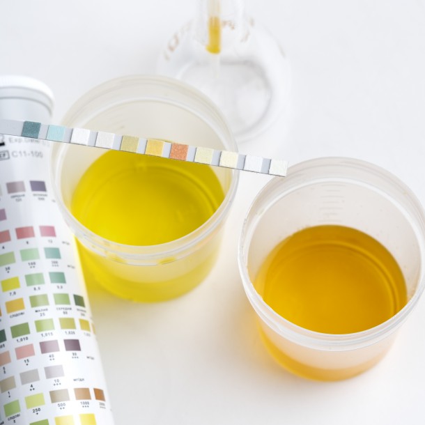 ¿Tu orina se ve verde? Esta es la explicación para los extraños colores ...