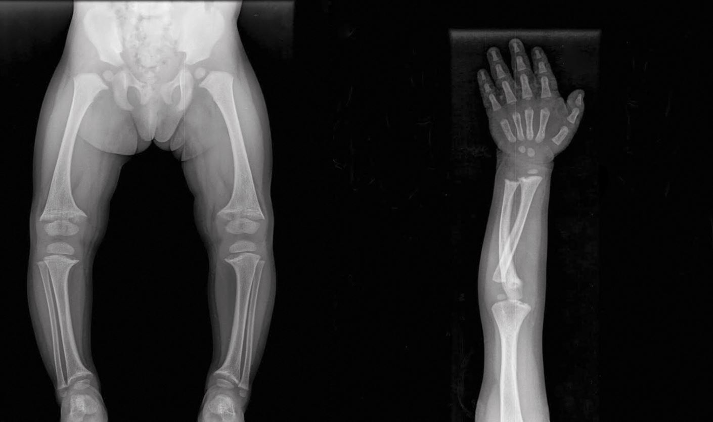 Raquitismo: La enfermedad del siglo XIX que vuelve a preocupar a un ...