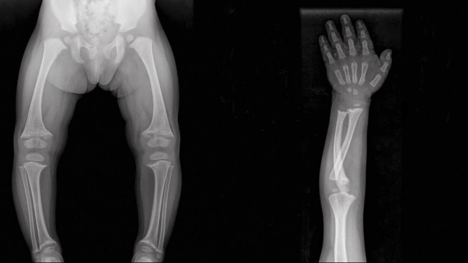 Raquitismo: La enfermedad del siglo XIX que vuelve a preocupar a un ...