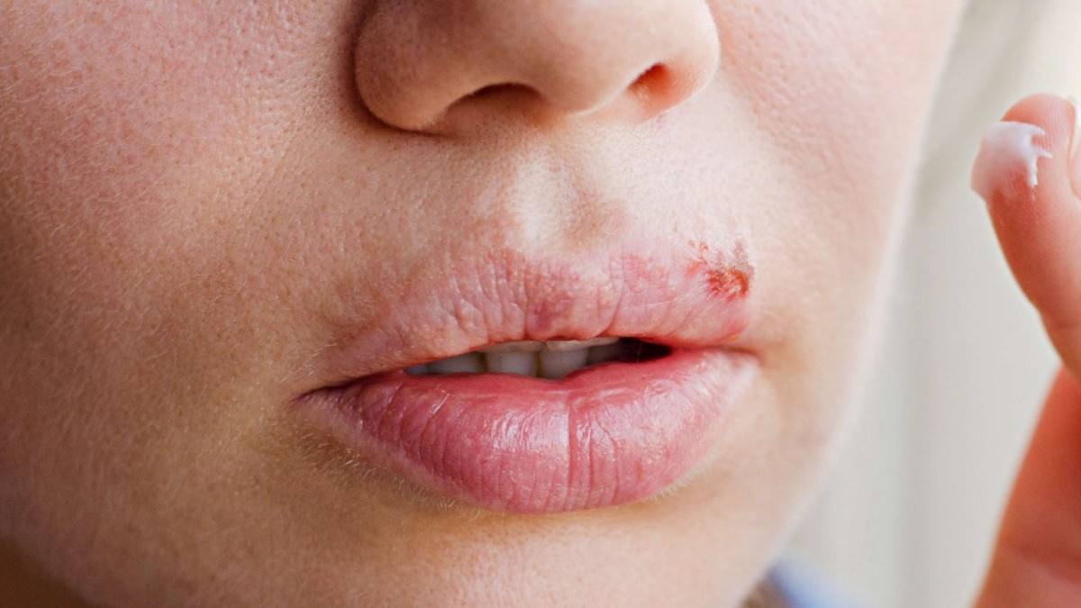 ¿Herpes labial o afta? Así puedes diferenciar ambas molestias bucales ...